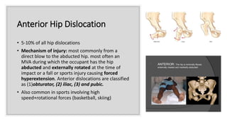 Hip Dislocations: Ortho topic presentation 2018 | PPT