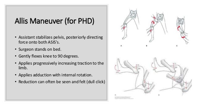 Hip Dislocations: Ortho topic presentation 2018