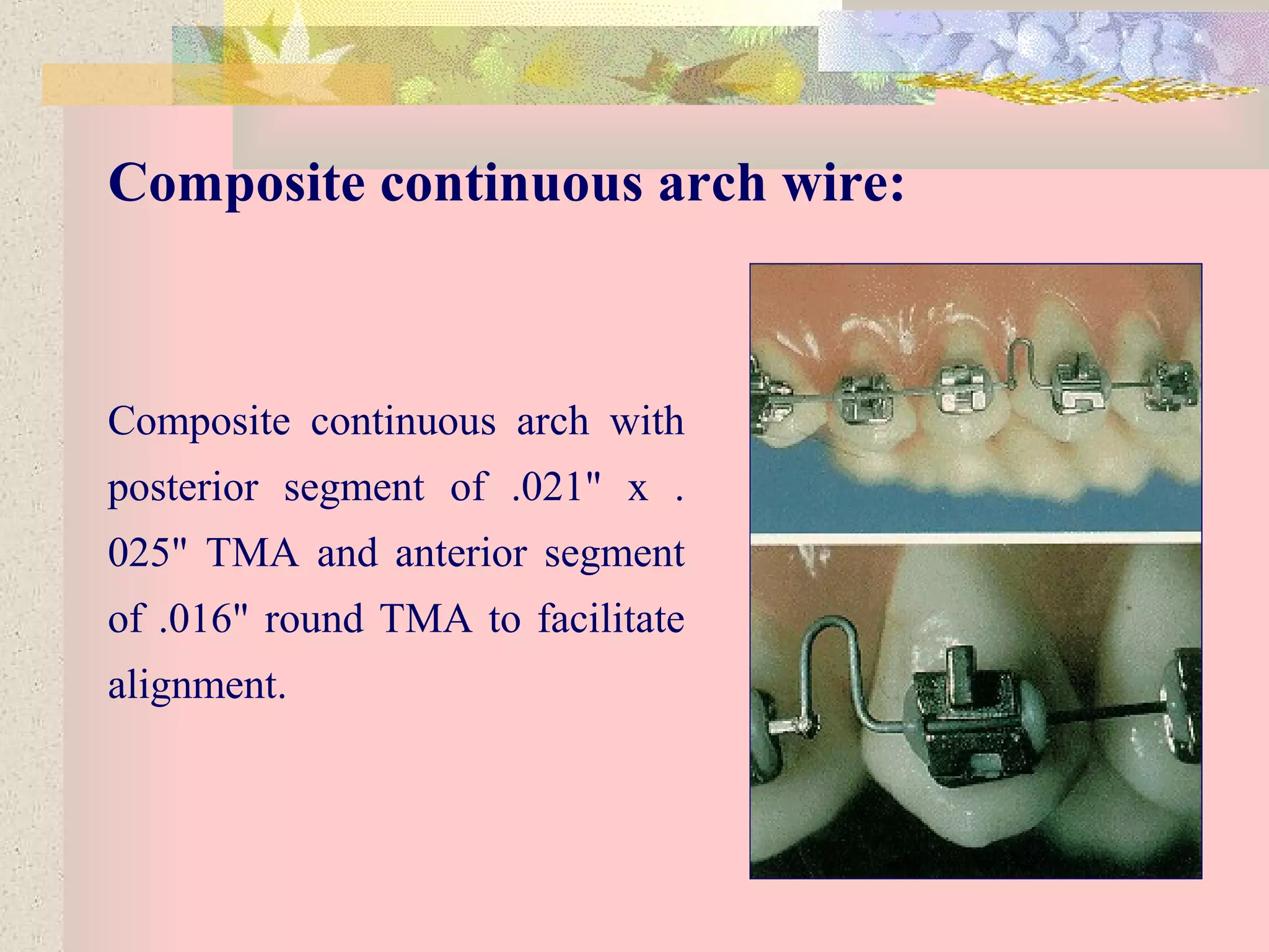 Ortho wires part iii | PPT