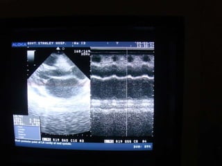 A case of Ortner's syndrome | PPT