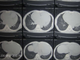 A case of Ortner's syndrome | PPT