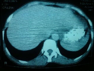 A case of Ortner's syndrome | PPT
