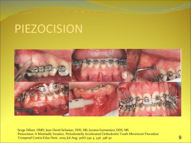 Ortodoncia asistida por corticotomias