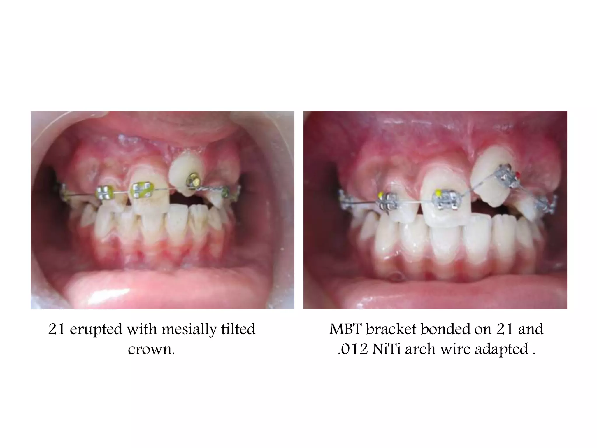 Ortodontic extrusion | PPTX
