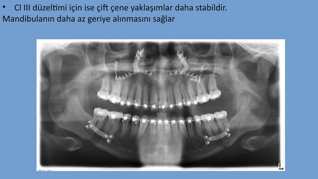 Ortognatik cerrahi sonrası relaps nedenleri | PPT