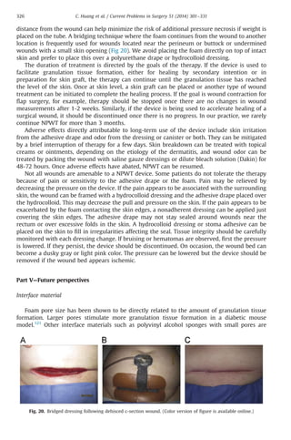effect of negative pressure wound therapy on wound healing | PDF