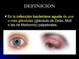 Orzuelo Chalazion | PPT