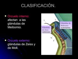 Orzuelo Chalazion | PPT