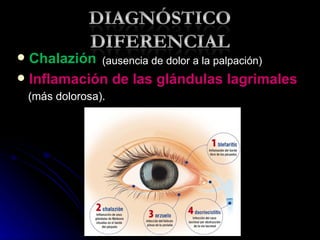 Orzuelo Chalazion | PPT