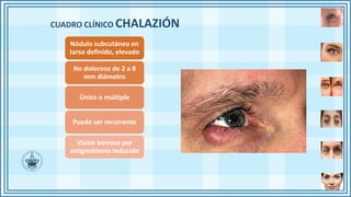 Orzuelo y chalazion | PPTX