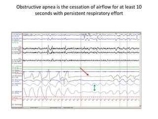 Obstructive Sleep Apnea (OSA) | PPTX