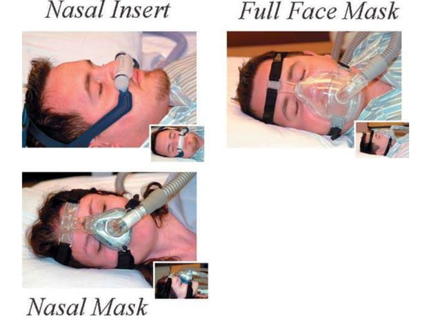 Obstructive Sleep Apnea (OSA) | PPTX | Sleep Disorders | Diseases and ...