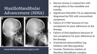 OBSTRUCTIVE SLEEP APNOEA TREATMENT | PPT