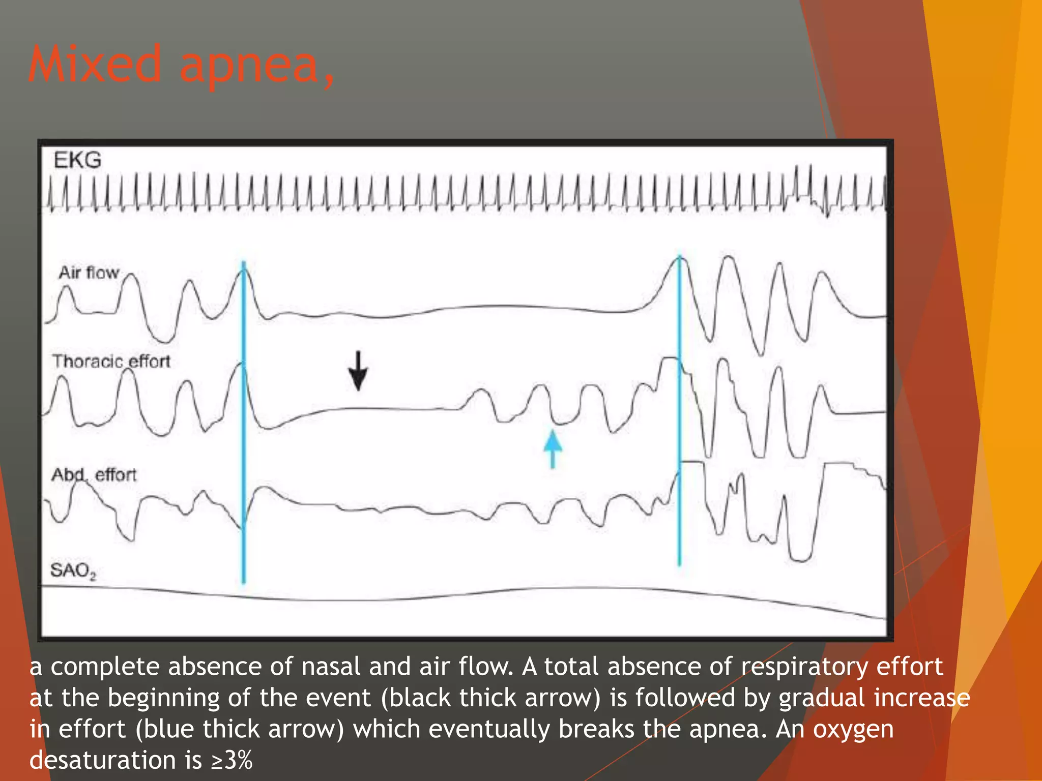 Obstructive Sleep Apnea | PPTX