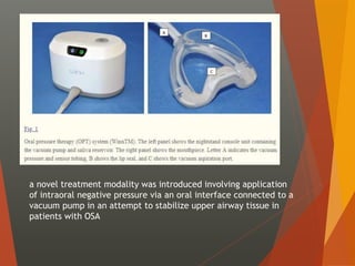 Obstructive Sleep Apnea | PPT