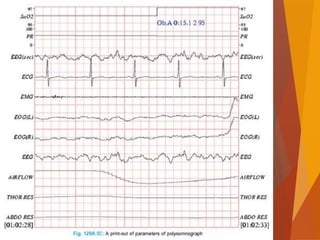 Obstructive Sleep Apnea | PPT