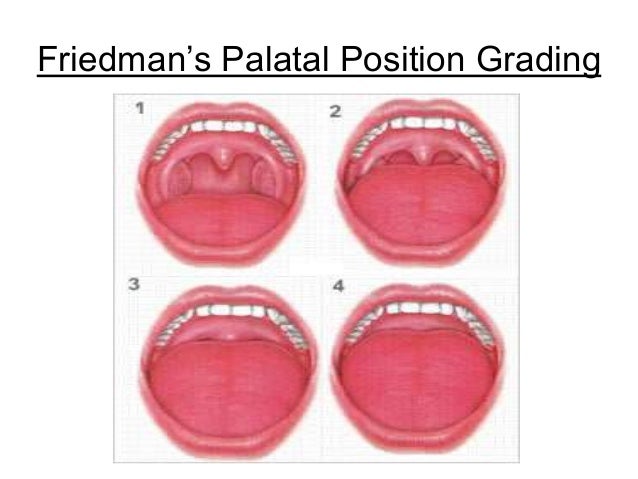 Obstructive Sleep Apnoea
