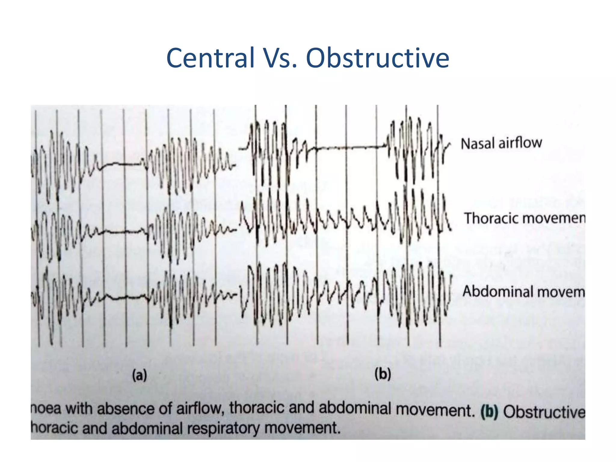 Obstructive Sleep Apnoea Ppt 0978