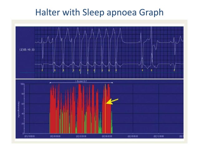 Obstructive Sleep Apnoea | PPT
