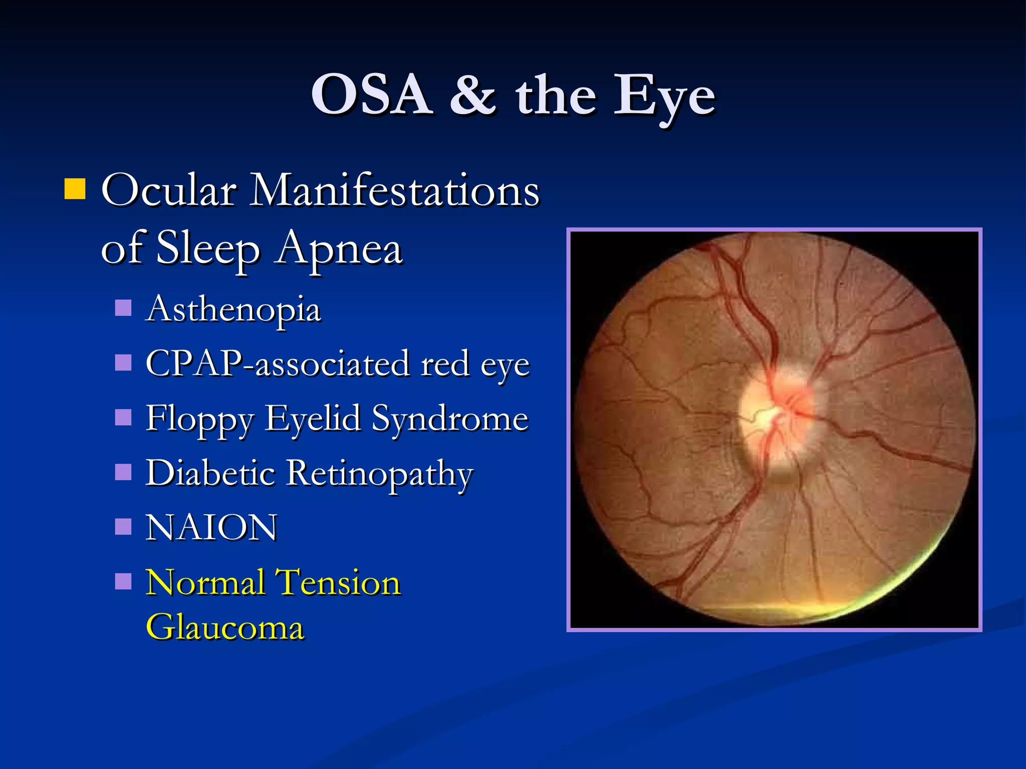 Sleep Apnea & The Eye - 2011 | PPT