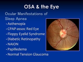 Sleep Apnea & The Eye 2015 | PPTX