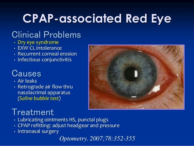 Sleep Apnea & The Eye 2015