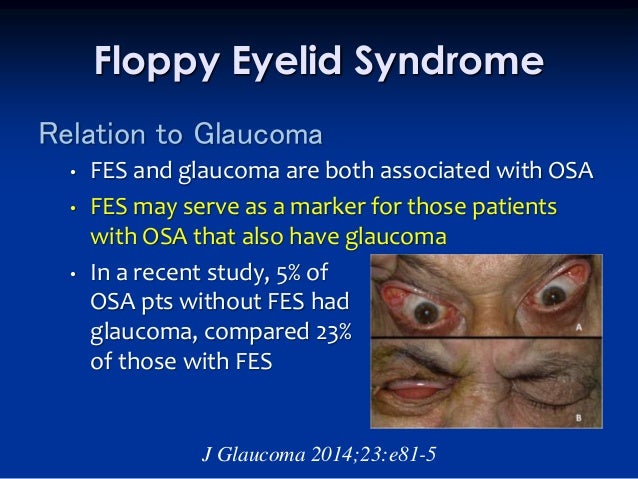 Sleep Apnea & The Eye 2015