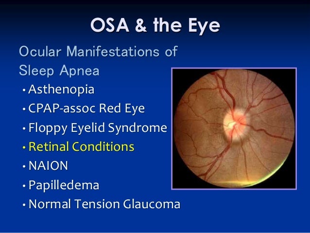 Sleep Apnea & The Eye 2015