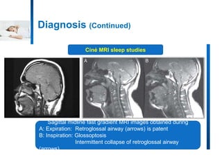 Perioperative considerations for OSA in Children | PPTX