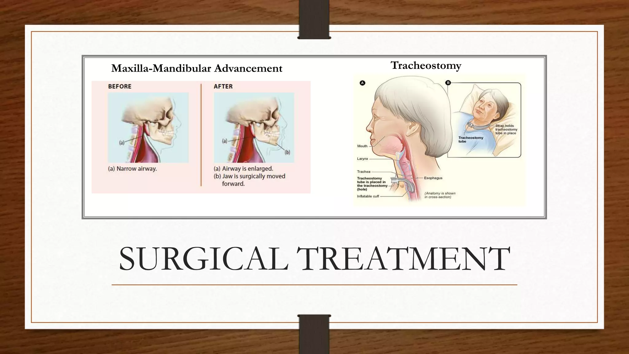 OSA (Obstructive Sleep Apnea) | PPT