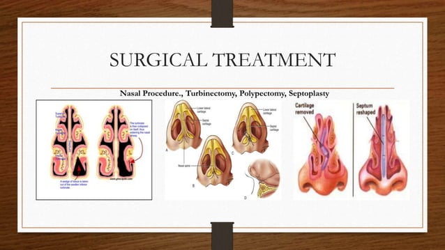 OSA (Obstructive Sleep Apnea) | PPT
