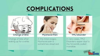 Mandibular Repositioning Appliances in Treating Obstructive Sleep Apnea ...