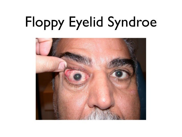 Osa in ophthlamology