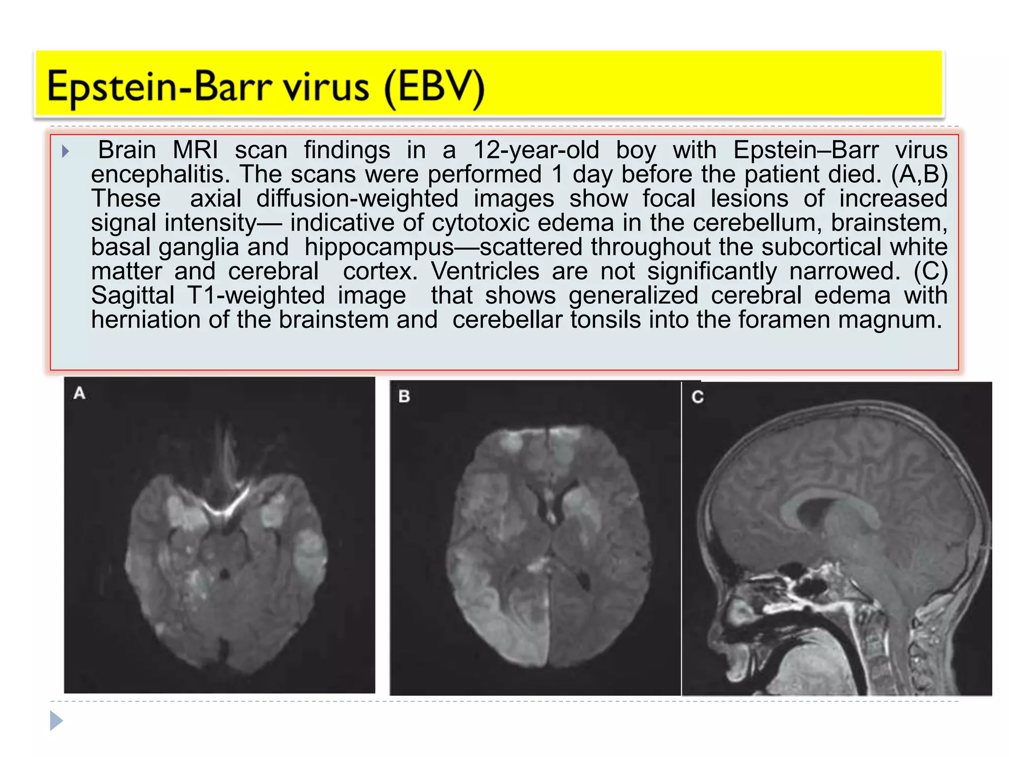 imaging of viral encephalitis | PPTX