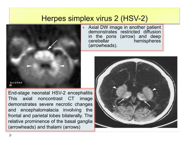imaging of viral encephalitis | PPTX | Infectious Diseases | Diseases ...