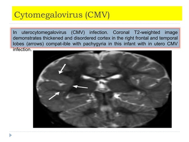 imaging of viral encephalitis | PPTX | Infectious Diseases | Diseases ...