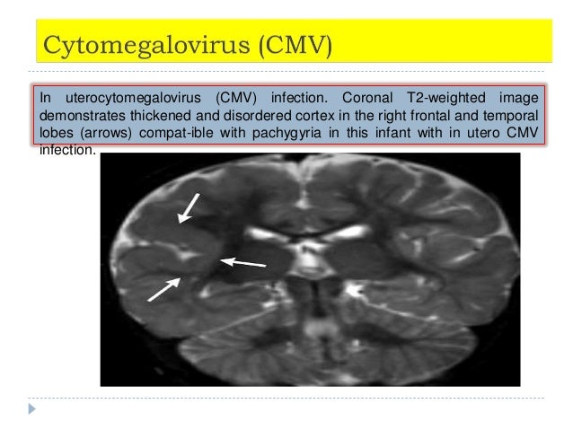 imaging of viral encephalitis