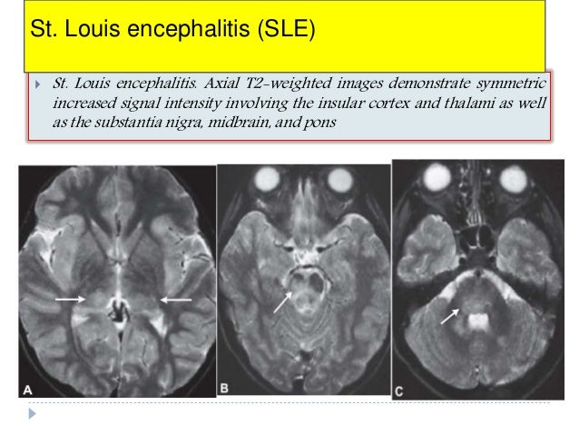 imaging of viral encephalitis