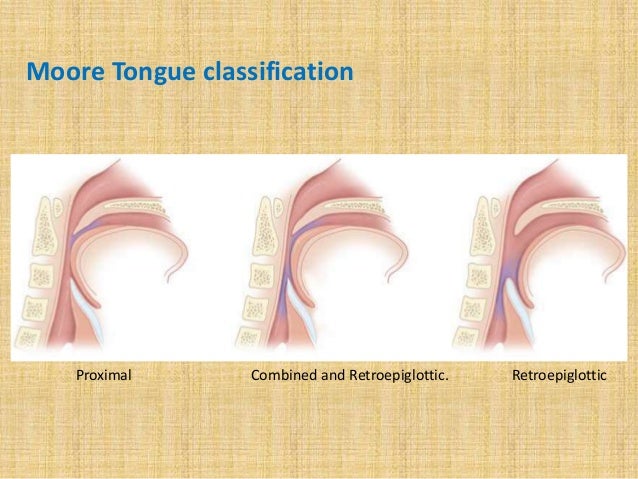 Obstructive Sleep Apnoea Syndrome