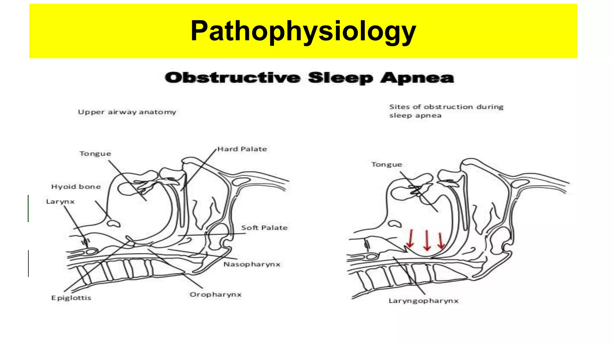 Obstructive sleep apnea | PPTX