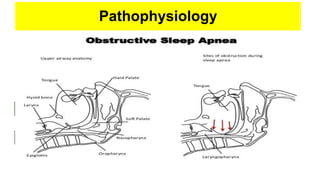 Obstructive sleep apnea | PPT