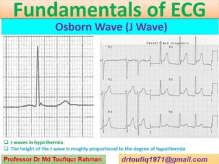 Osborne wave(J wave) and j point in ECG | PPSX | Heart and ...