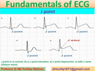Osborne wave(J wave) and j point in ECG | PPSX | Heart and ...