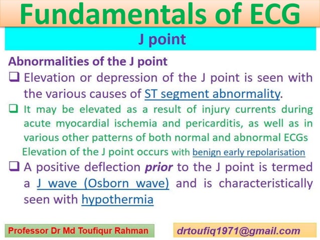 Osborne wave(J wave) and j point in ECG | PPSX | Heart and ...