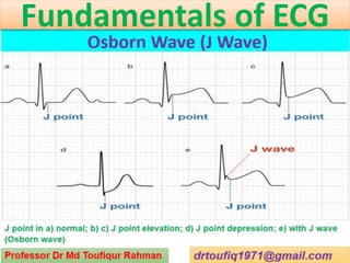 Osborne wave(J wave) and j point in ECG | PPSX | Heart and ...