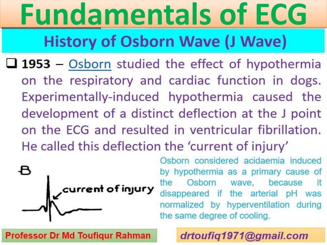 Osborne wave(J wave) and j point in ECG | PPSX | Heart and ...