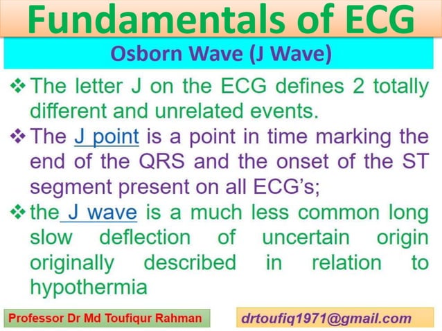 Osborne wave(J wave) and j point in ECG | PPSX | Heart and ...