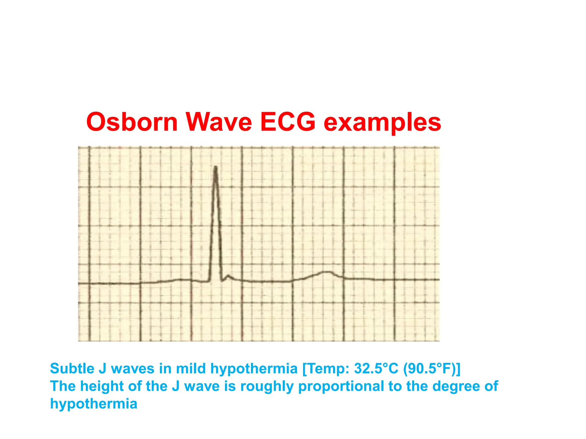 OSBORN WAVE (J Wave) IN ECG AND ITS INTERPRETATION | PPT