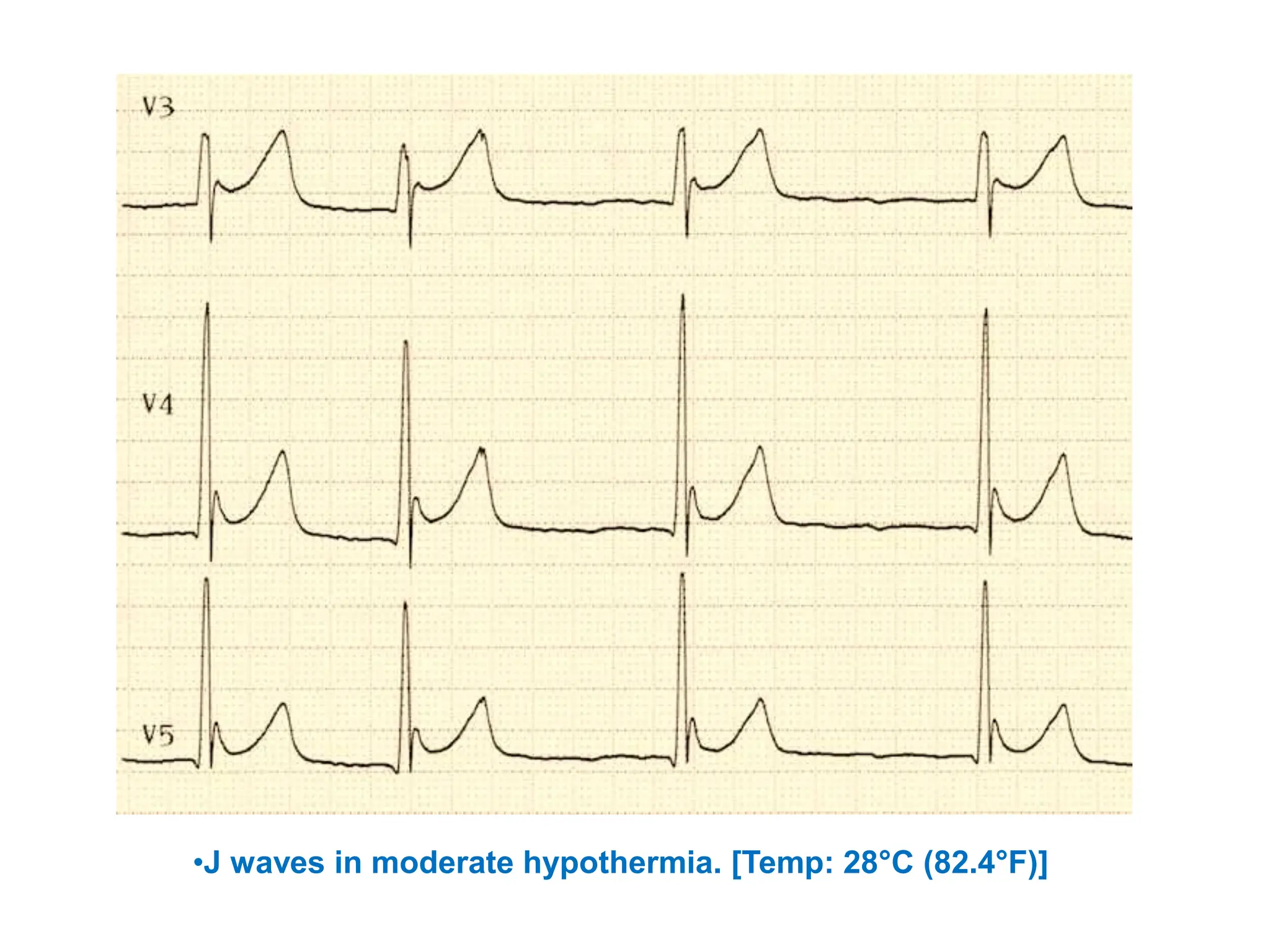 OSBORN WAVE (J Wave) IN ECG AND ITS INTERPRETATION | PPT