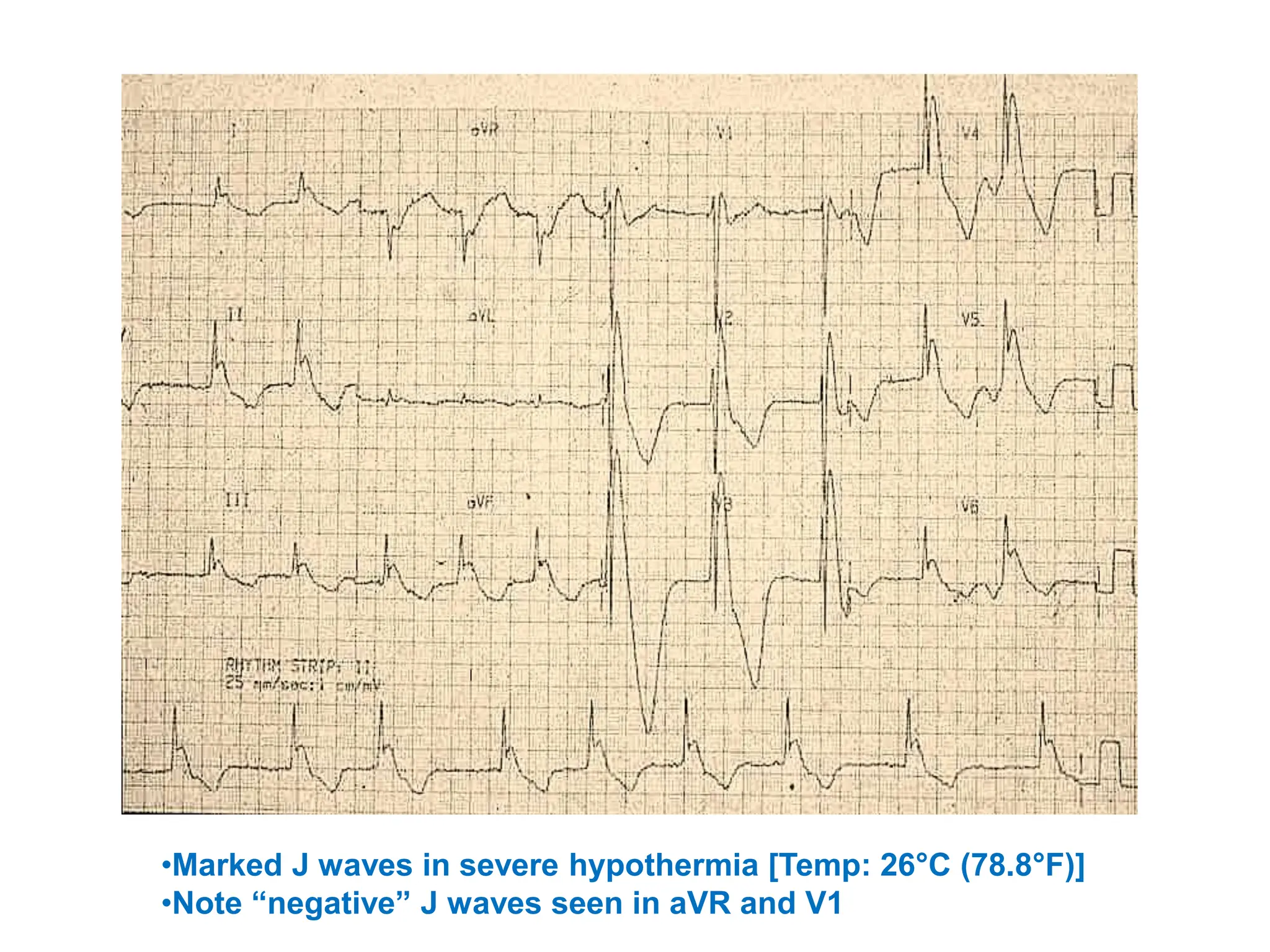 OSBORN WAVE (J Wave) IN ECG AND ITS INTERPRETATION | PPT